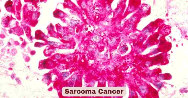 Sarcoma Cancer: Types, Symptoms, Diagnosis, and Treatment Options – The ...